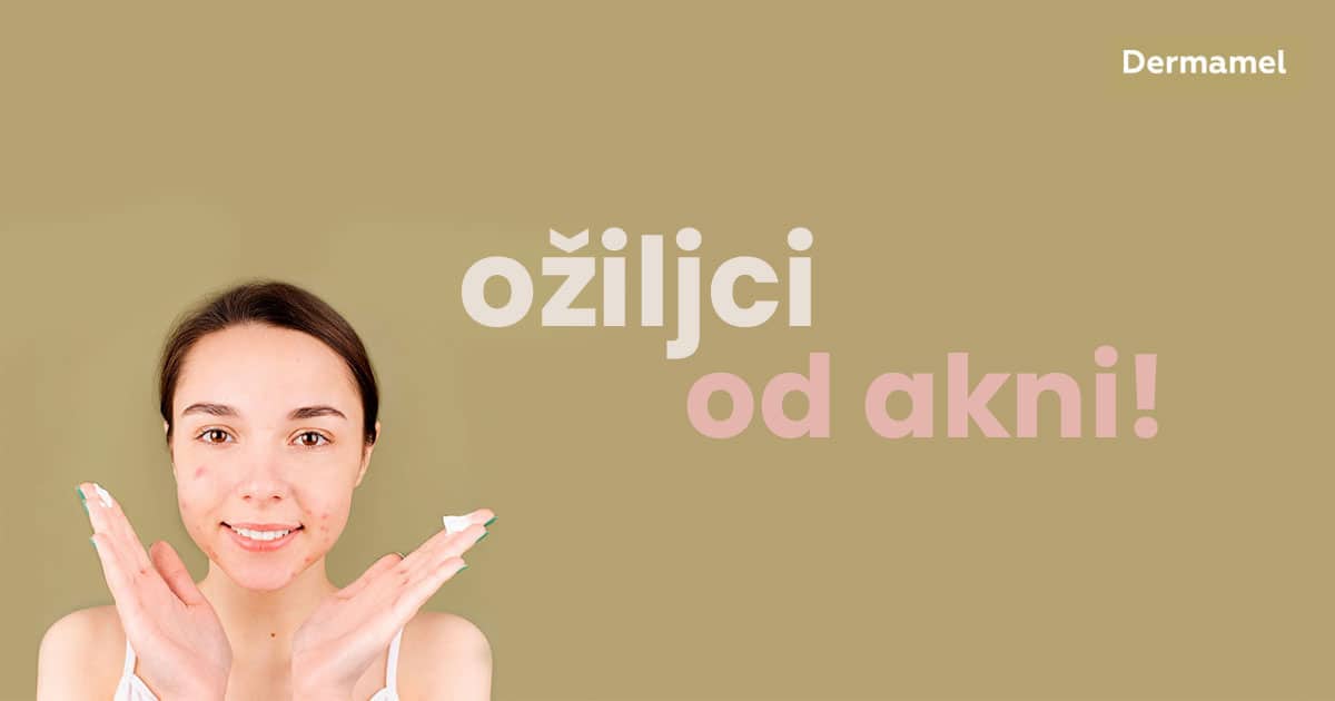 Ožiljci i akne - Dermamel
